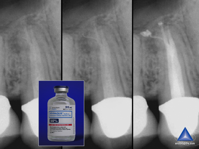 Ruddle Inventions | Advanced Endodontics