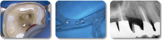 EndoActivator System | Advanced Endodontics