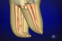 Invention: Calamus Dual Obturation System | Advanced Endodontics