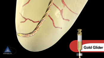 Invention: Endodontic Access Kit | Advanced Endodontics