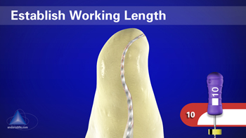 ProGlider File | Advanced Endodontics