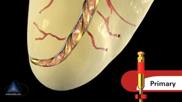 Invention: WaveOne GOLD | Advanced Endodontics