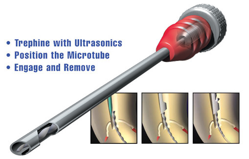 Invention: File Removal System | Advanced Endodontics