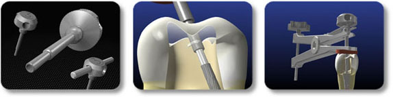 Invention: Post Removal System Kit | Advanced Endodontics