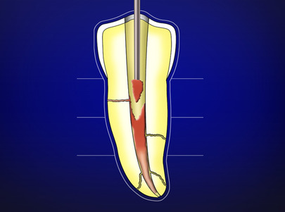 Vertical Condensation Technique - Step-by-Step Graphic Sequence