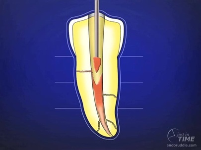 3-D Obturation - Vertical Compaction Sequence